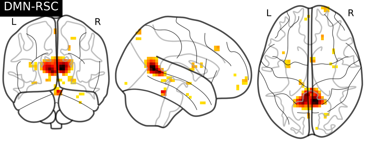 Malone researchers present AI Labeling of Brain Activity at ...