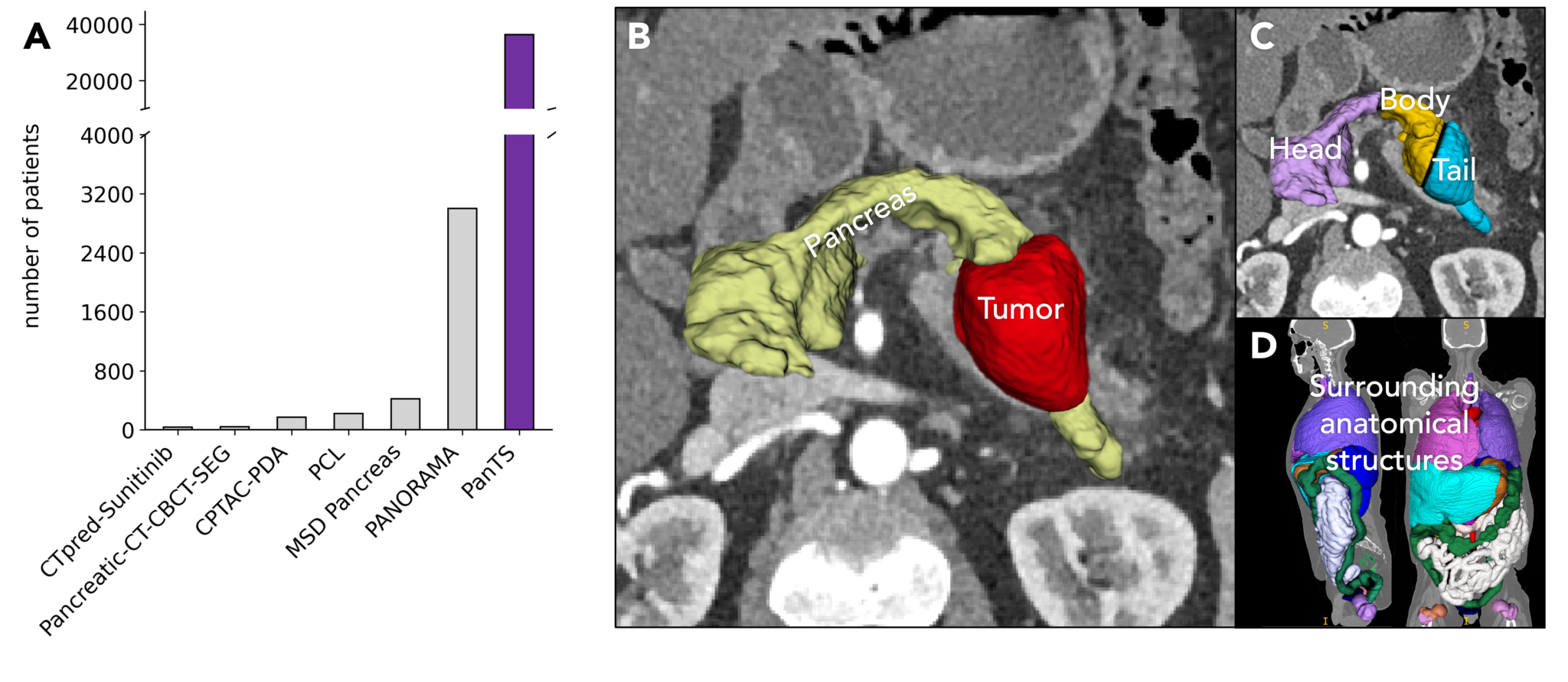 Hold on to your PanTS—there’s a new pancreatic cancer detection dataset ...